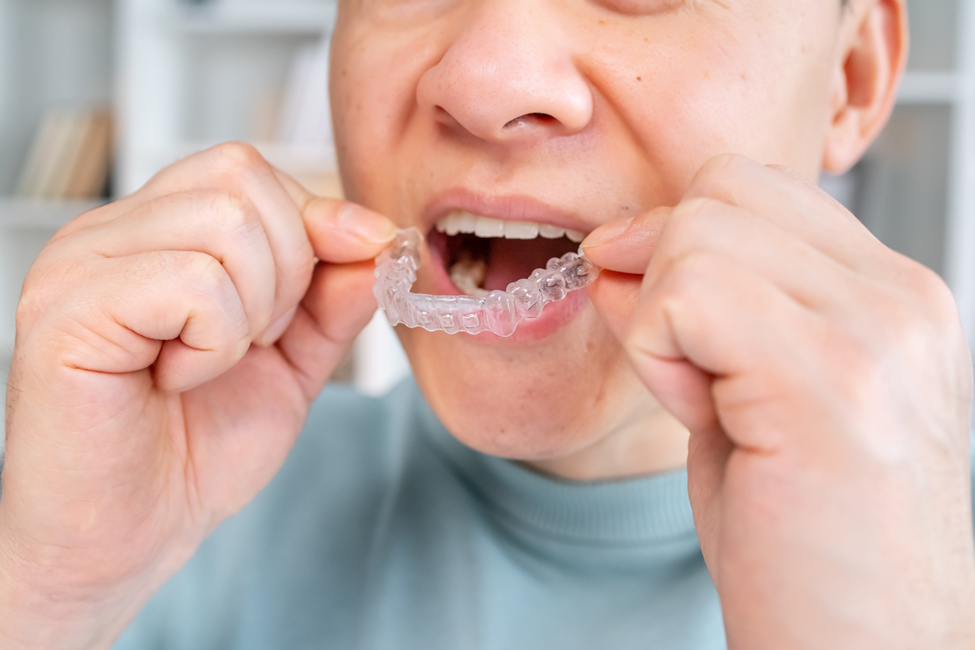 What Should I Do If My Invisalign Doesn't Fit? | Dr. George A. Hooper
